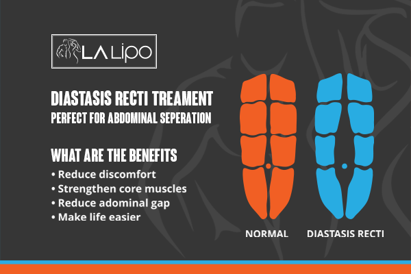 Diastasis Recti Treatment Guildford Book Now